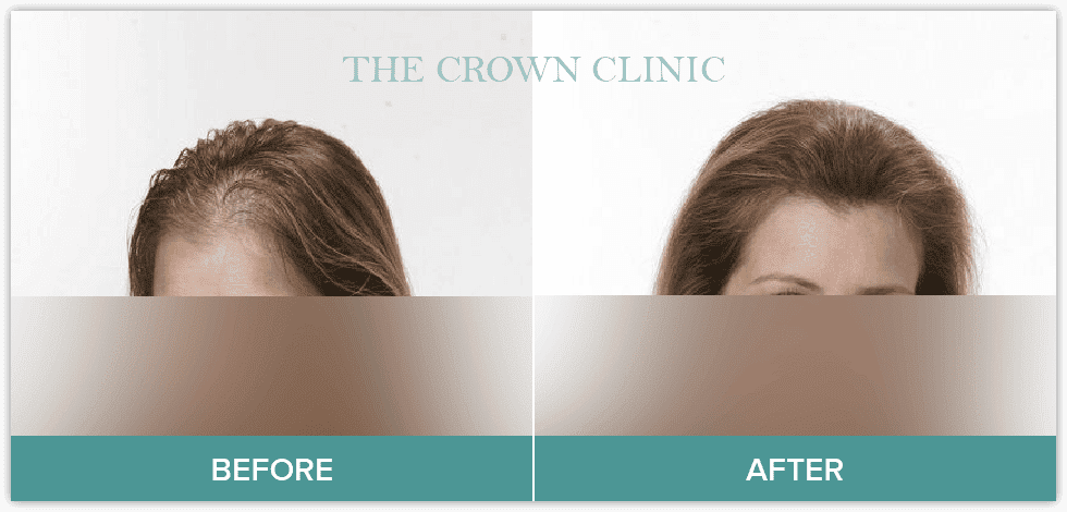 Hair Loss Medication Sydney | The Crown Clinic