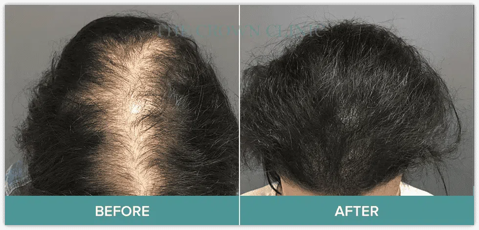 SMP Scalp Micropigmentation Sydney | The Crown Clinic